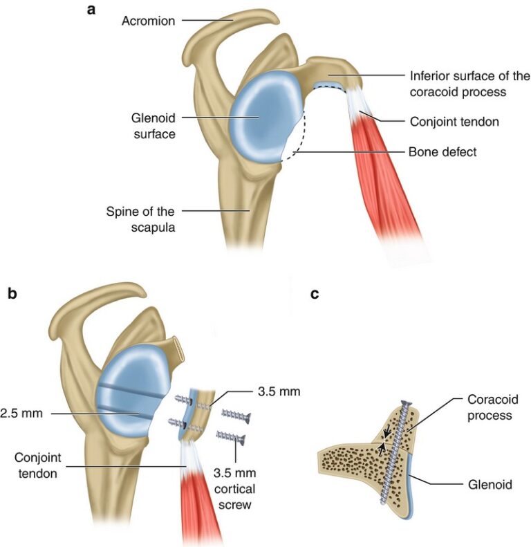 Shoulder Instability - Sun Orthopaedic