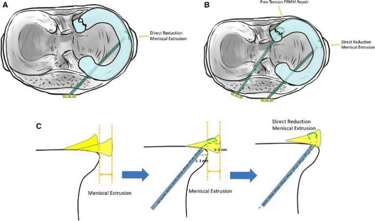 Meniscus Root Tear - Sun Orthopaedic